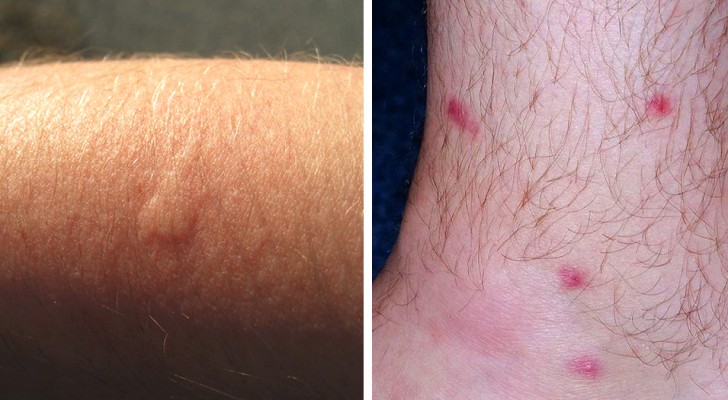 Insect bites: Here are the 10 most common and how to distinguish them ...